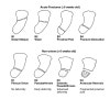주상골 골절scaphoid Fracture 넘어진 뒤에 엄지 손가락 쪽 손목이 아파요 네이버 블로그